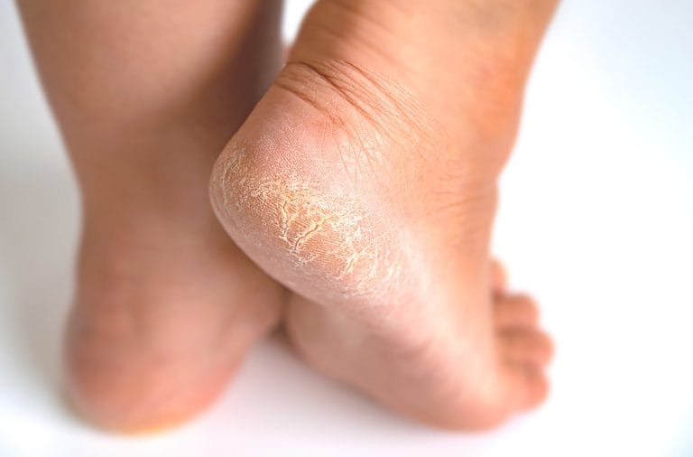 Adelaide Treatment For Corns And Calluses - Rose Park Podiatry