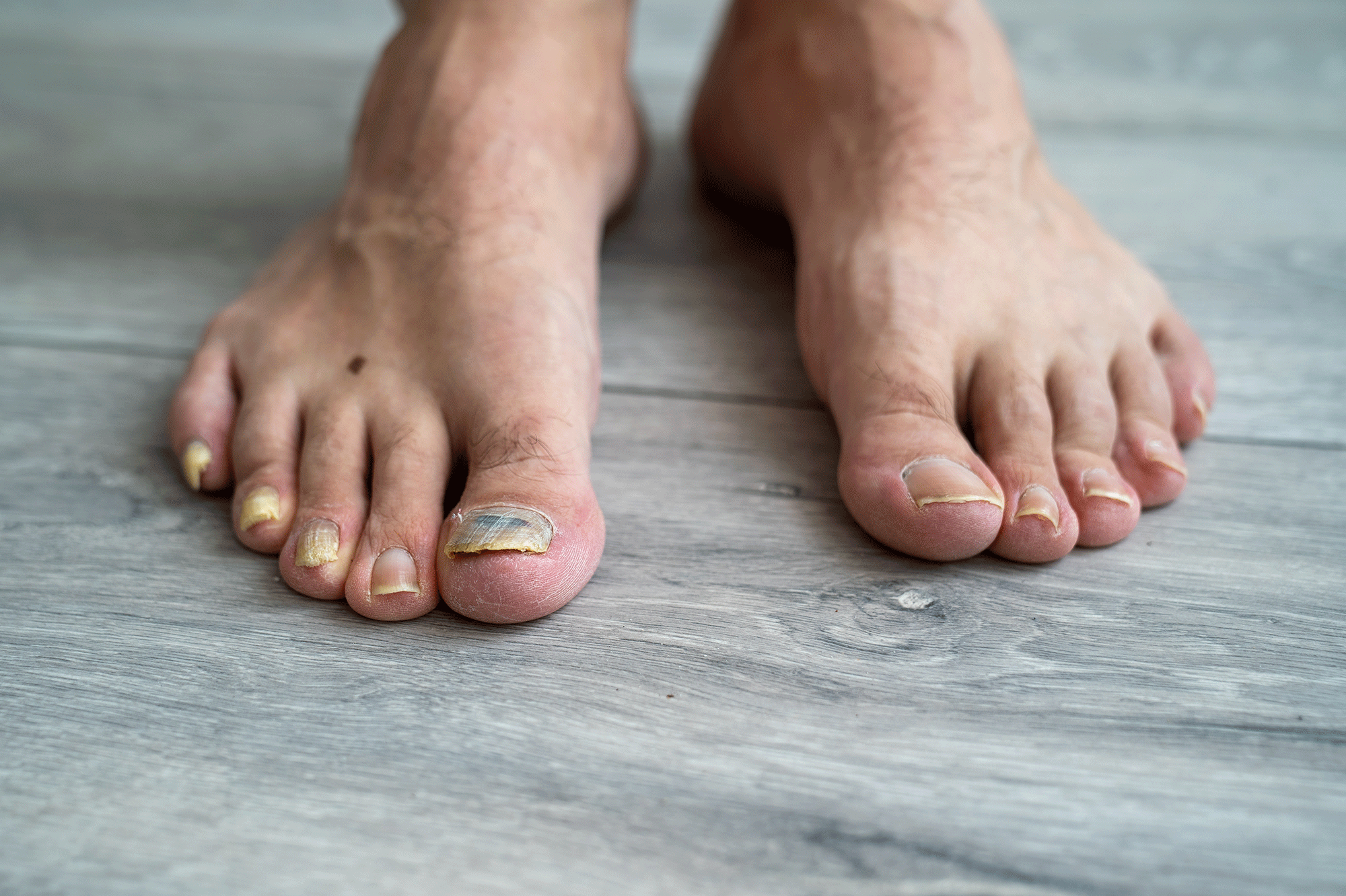 Toenail Fungal Infections—Causes, Symptoms & Treatments - Rose Park ...